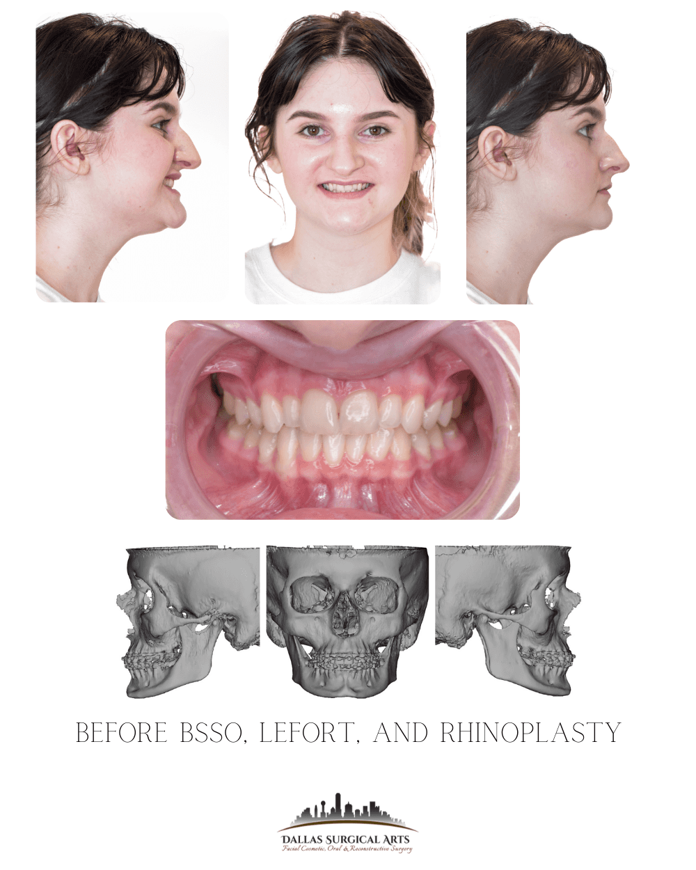 Jaw Repositioning (Orthognathic Surgery) | Dallas Surgical Arts